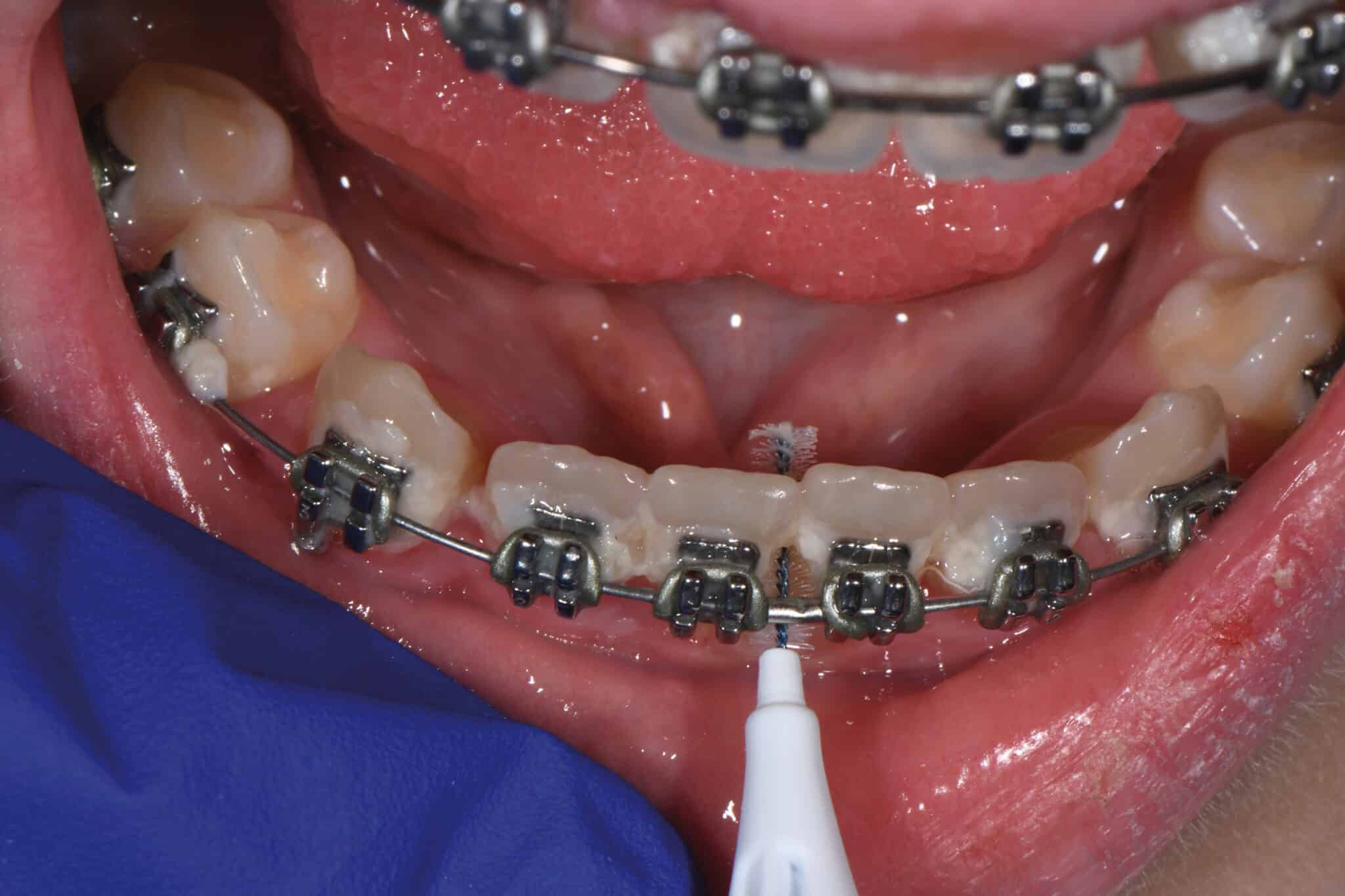 Igiene orale con l’apparecchio ortodontico - Curasept S.p.a.